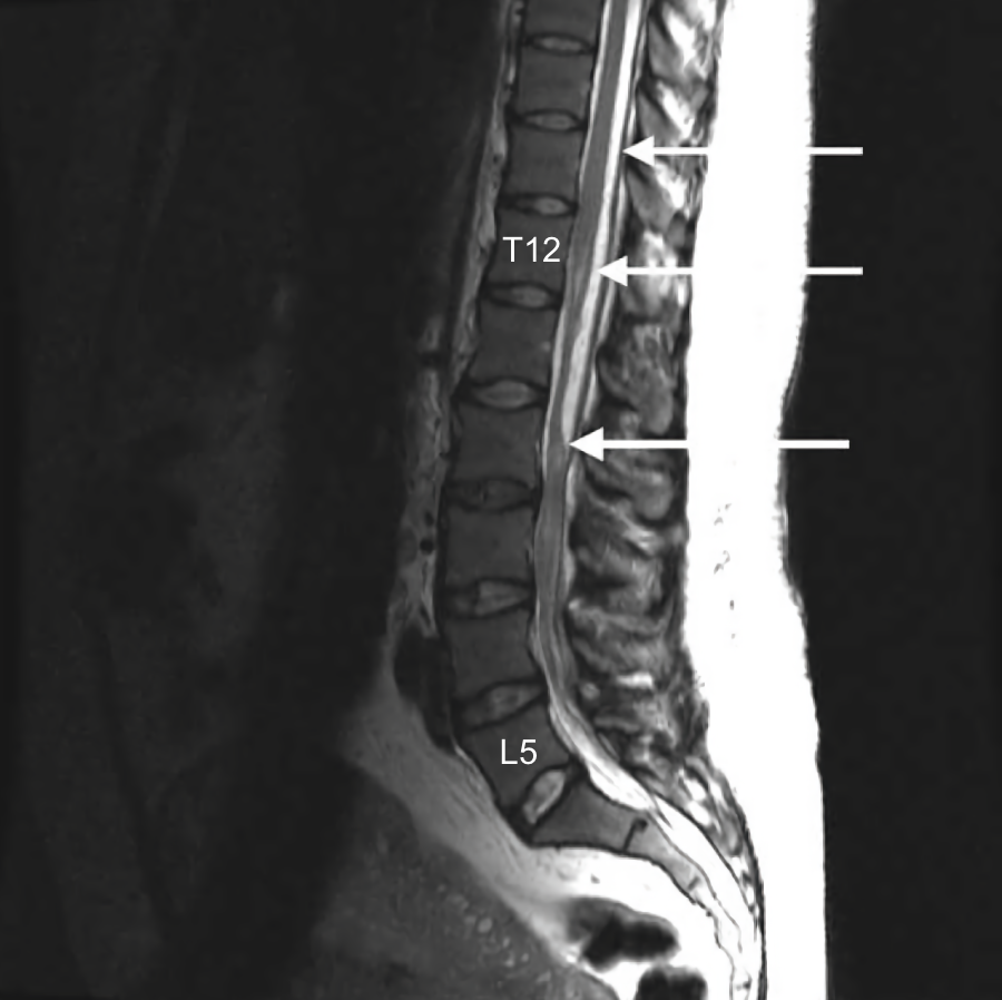 Complicaciones por parche hemático epidural – Anestesiología Mexicana ...