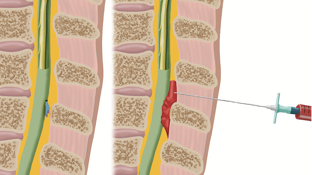 Resonancia magnética nuclear (RMN) del parche hemático epidural ...