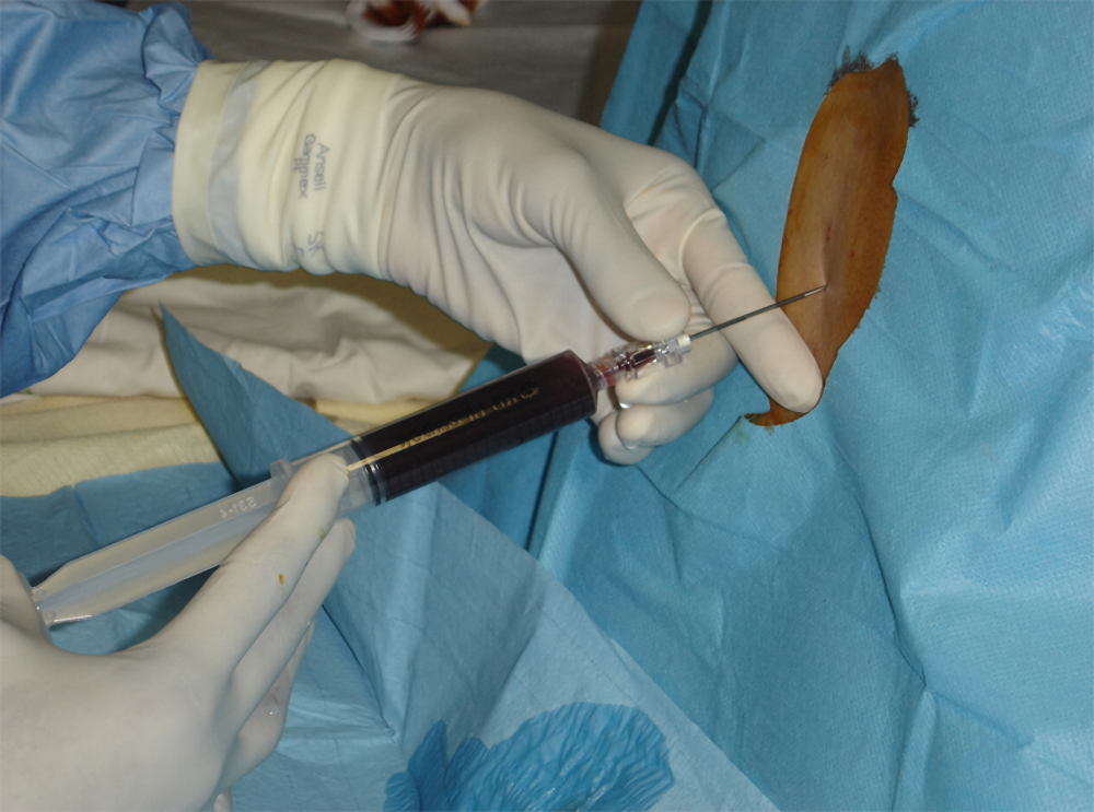 Nacimiento de una idea: el parche hemático epidural – Anestesiología ...